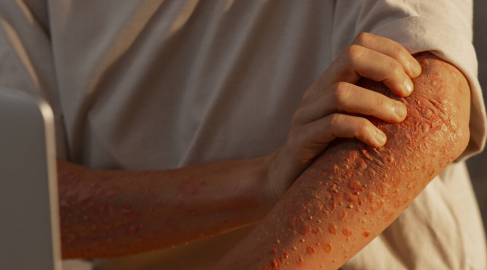 Qué es la sarna en humanos, síntomas y cómo se trata